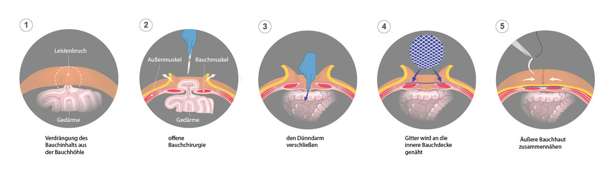 Leistenbruch und Co. - Expertenratgeber